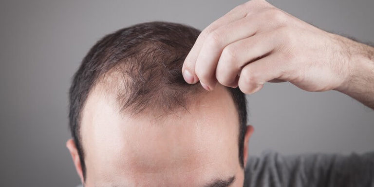Comment savoir si on a une calvitie